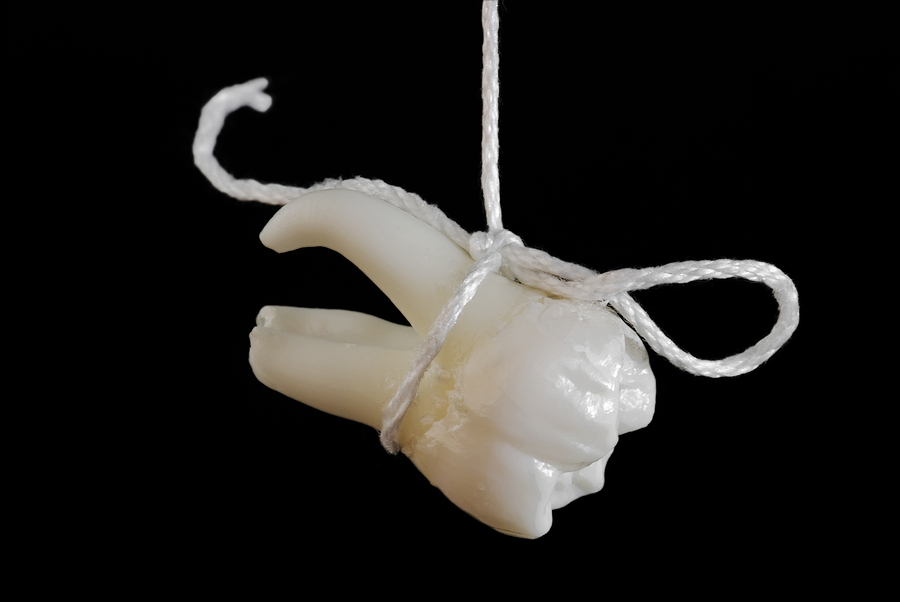 Tooth Extractions in Hurst TX | Brookshire Dentistry
